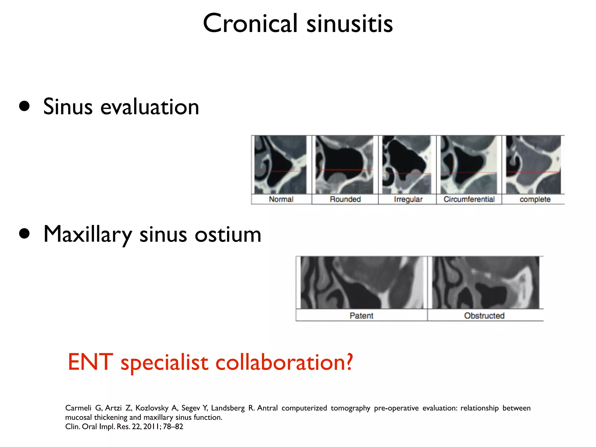 Sinus Lift and Immediate Implant Placement | PDF