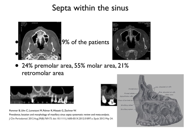 Sinus Lift and Immediate Implant Placement | PDF