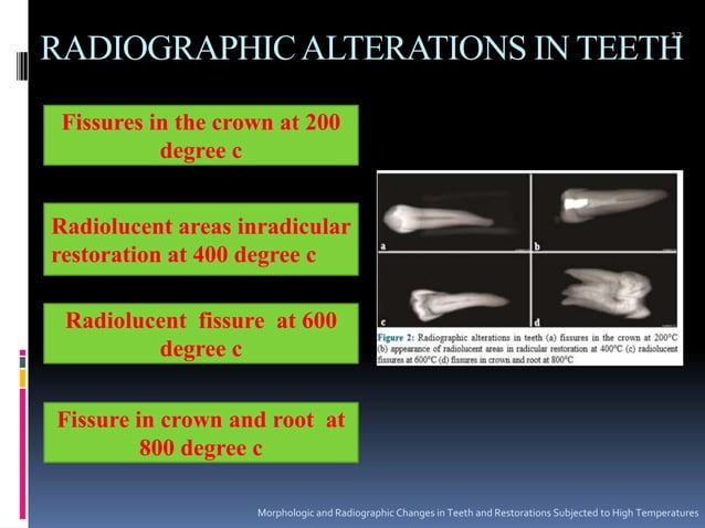 MORPHOLOGICAL AND RADIOGRAPHIC CHANGES IN TEETH AND RESTORATION ...