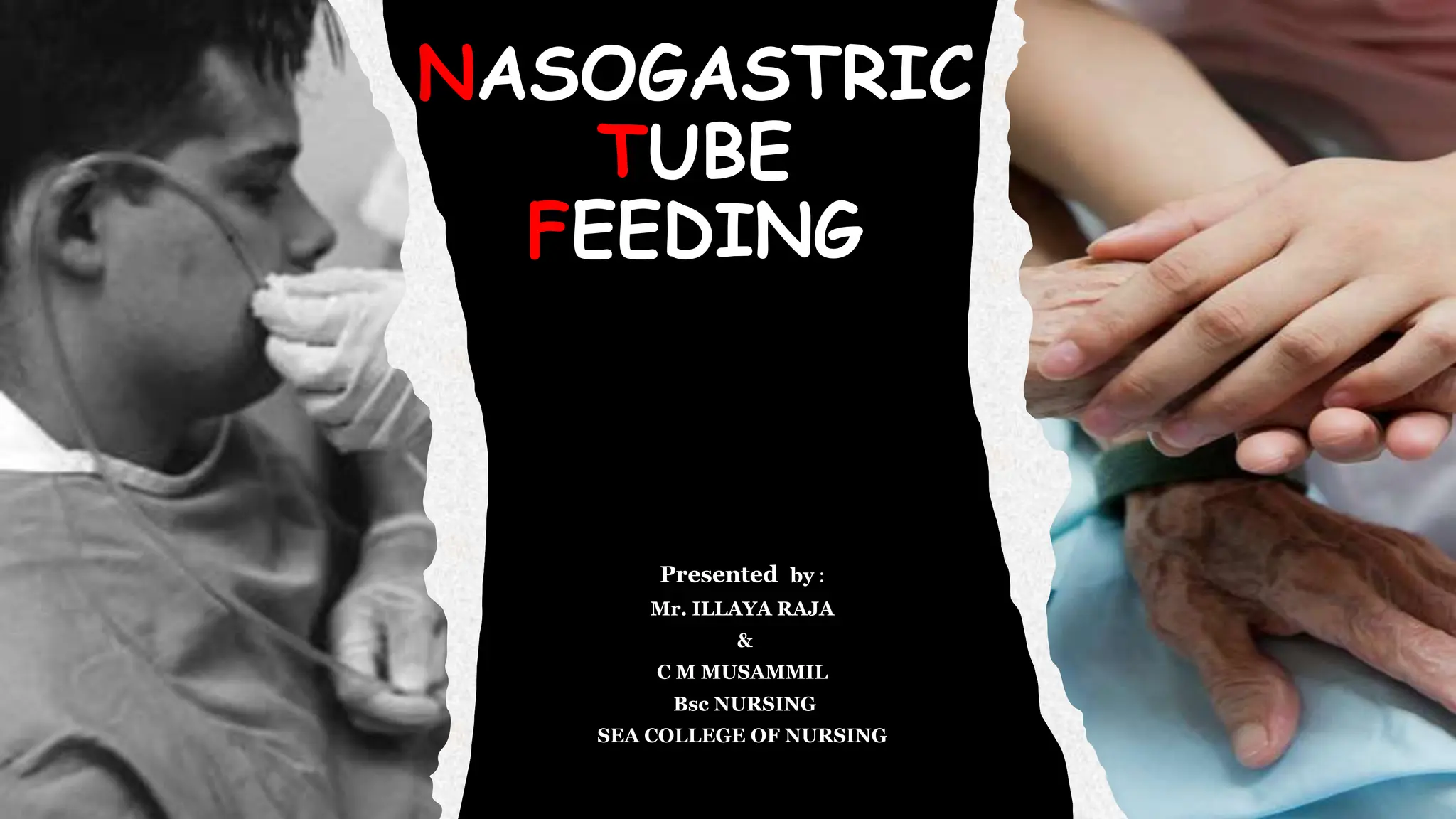 NASOGASTRIC TUBE FEEDING or NG tube feeding | PPTX