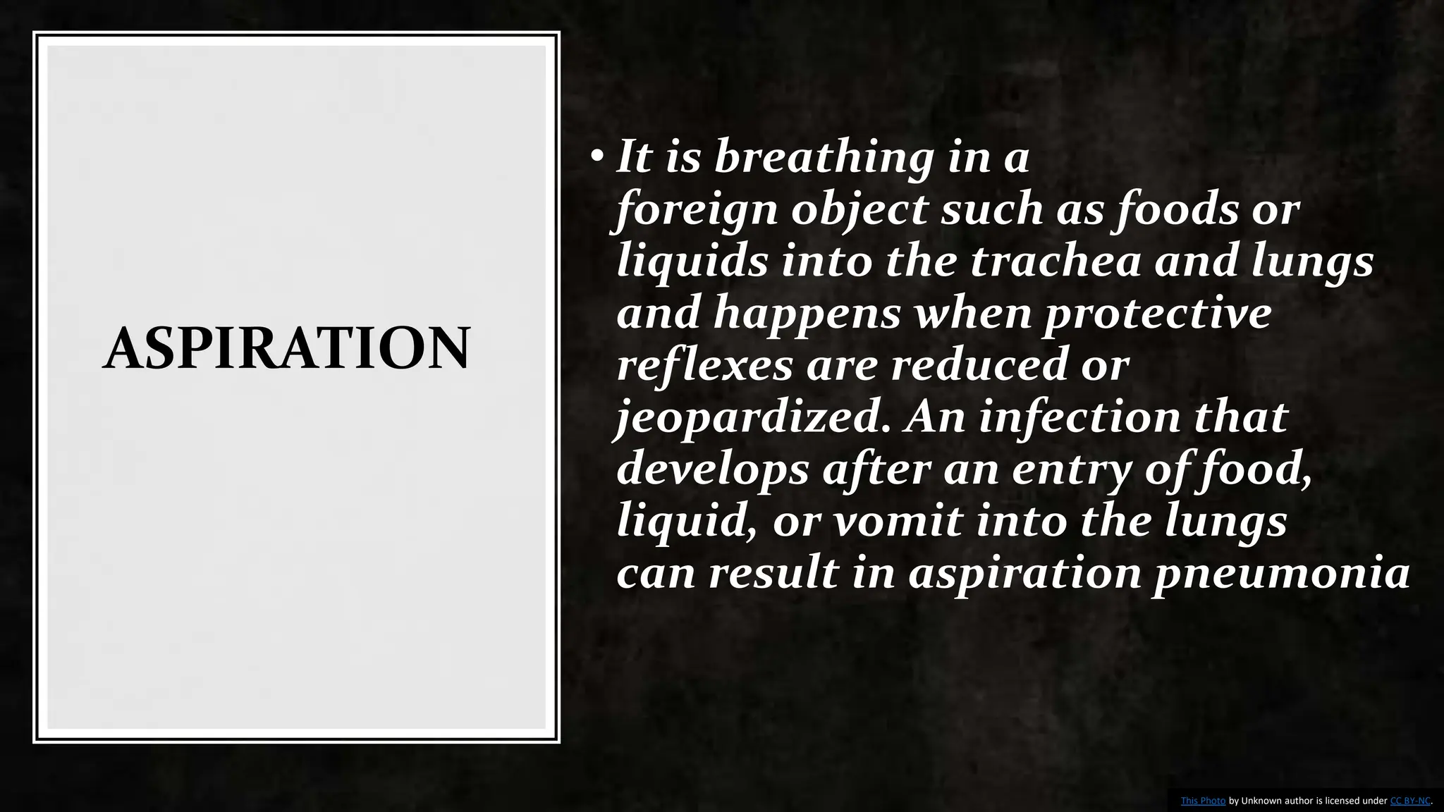 NASOGASTRIC TUBE FEEDING or NG tube feeding | PPTX