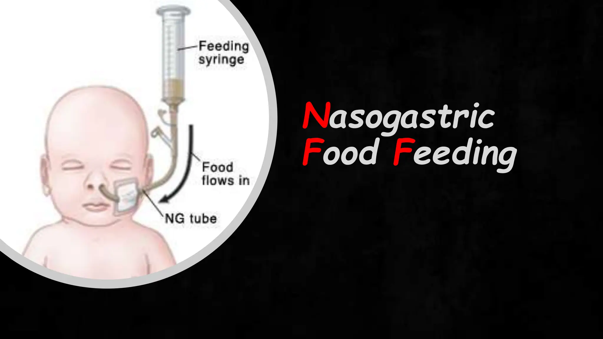 NASOGASTRIC TUBE FEEDING or NG tube feeding | PPTX