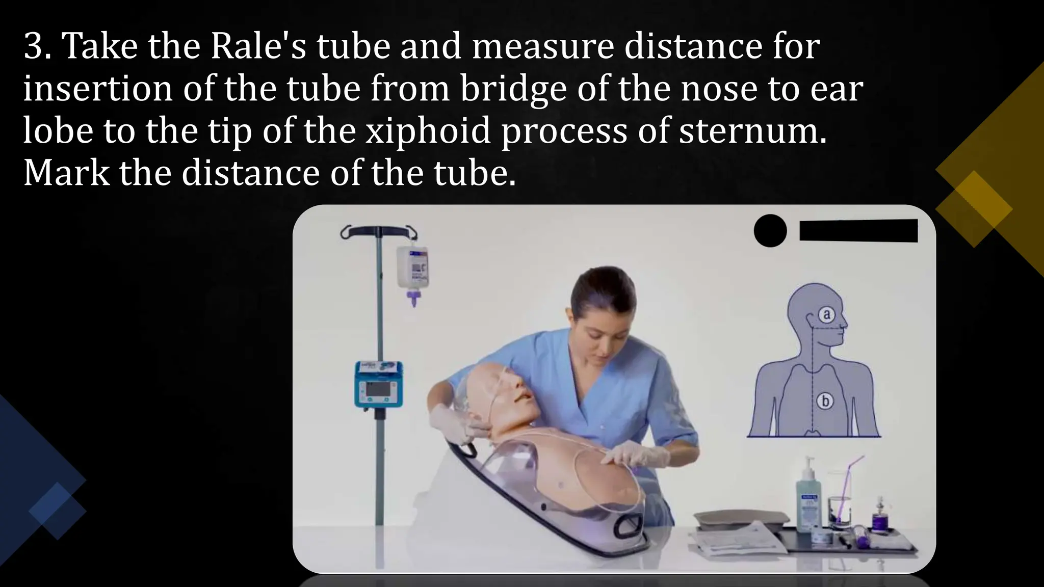 NASOGASTRIC TUBE FEEDING or NG tube feeding | PPTX