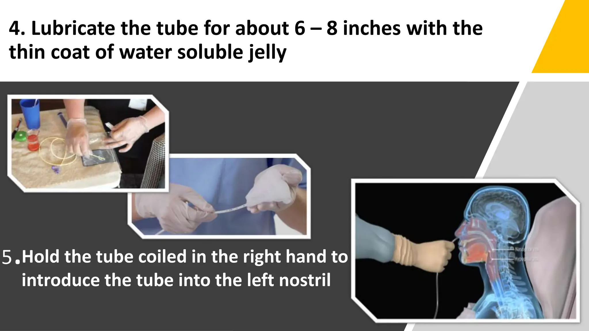 NASOGASTRIC TUBE FEEDING or NG tube feeding | PPTX