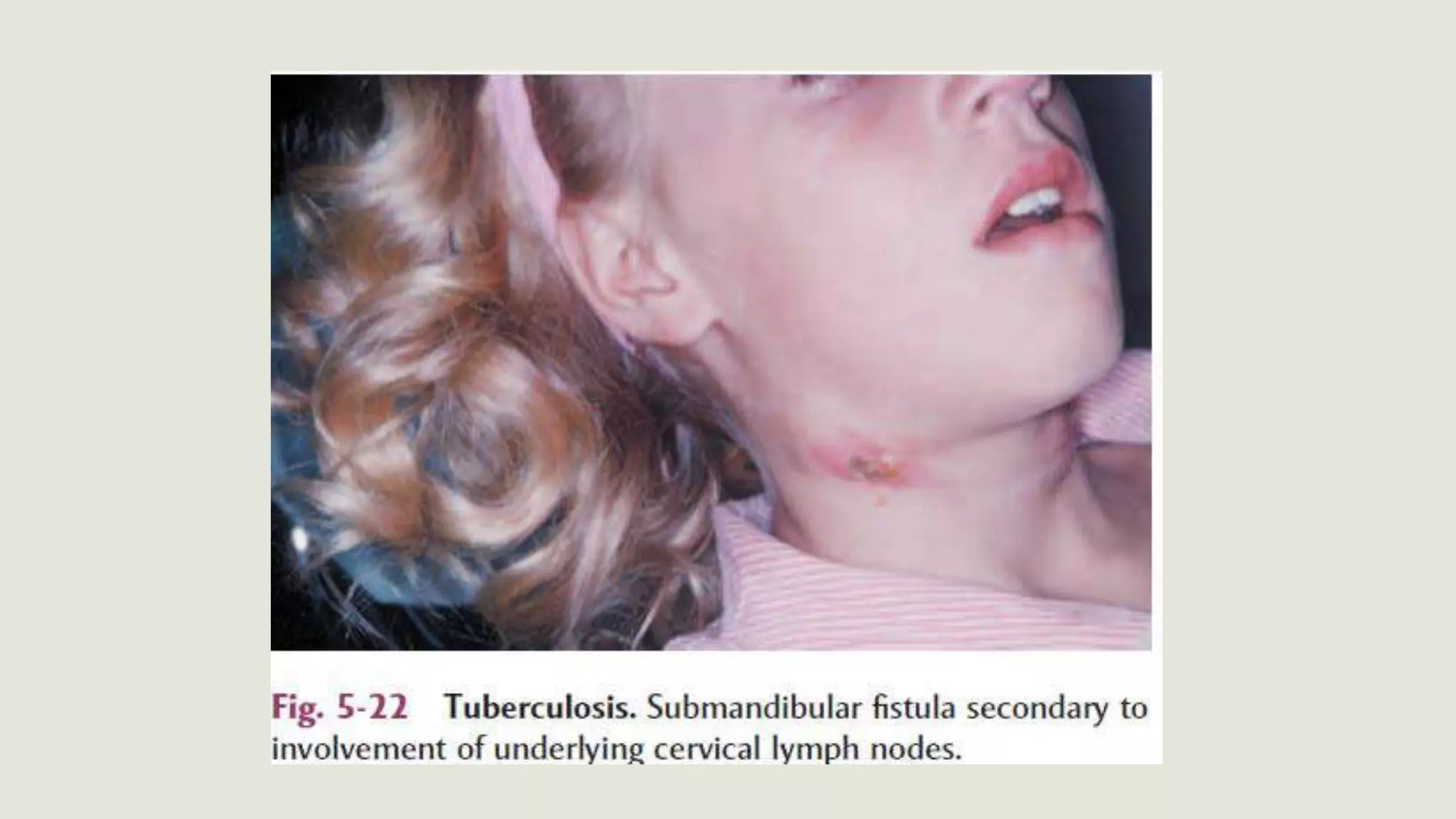 Bacterial Infections Of Oral Cavity Pptx