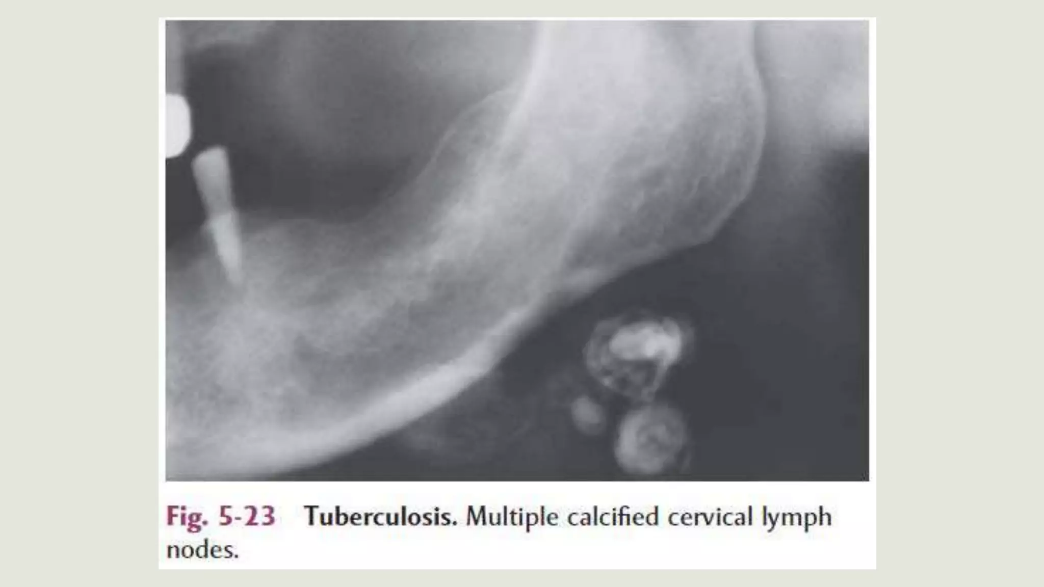 Bacterial Infections Of Oral Cavity Pptx