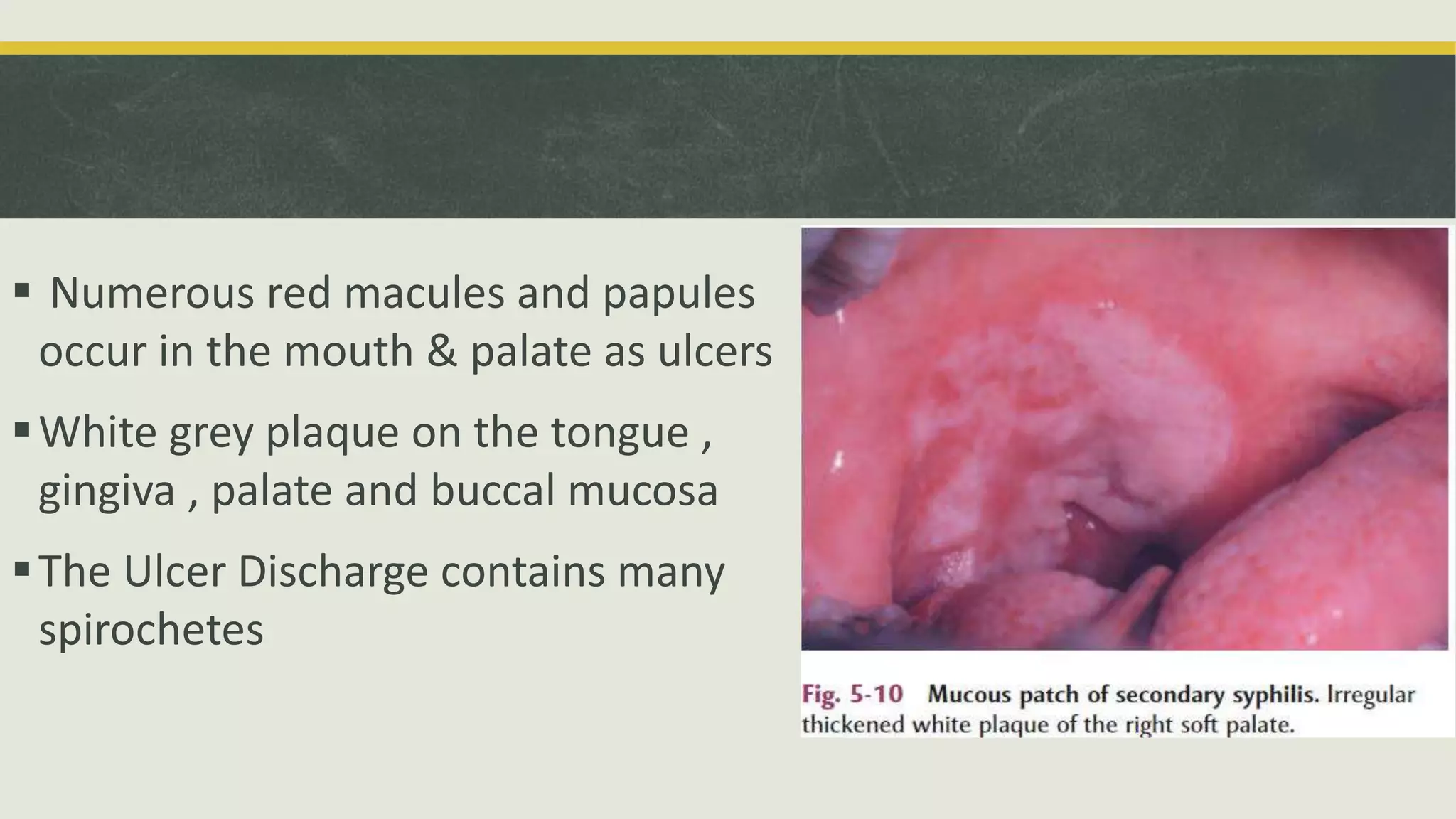 Bacterial Infections of Oral Cavity | PPTX