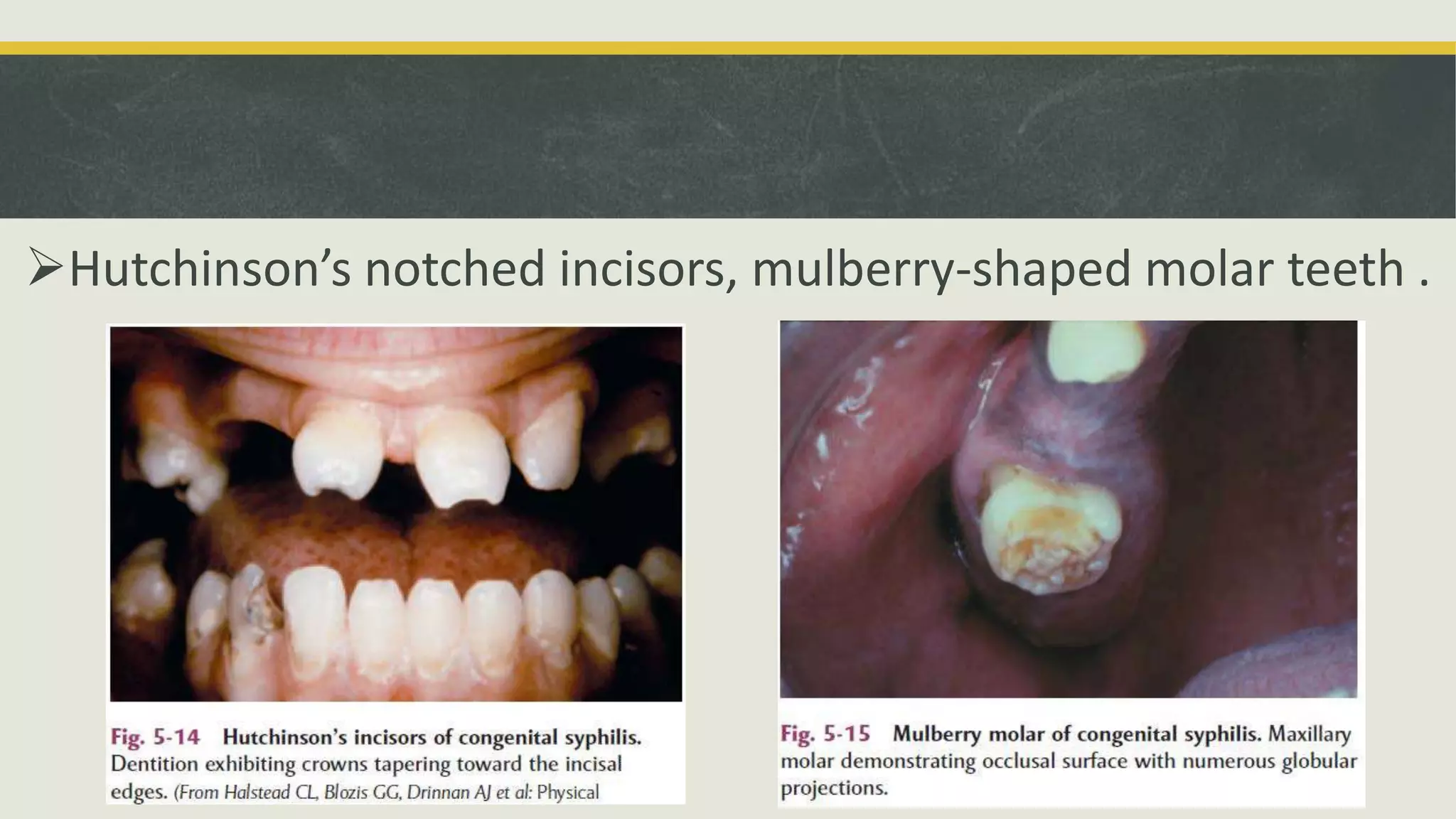 Bacterial Infections of Oral Cavity | PPTX