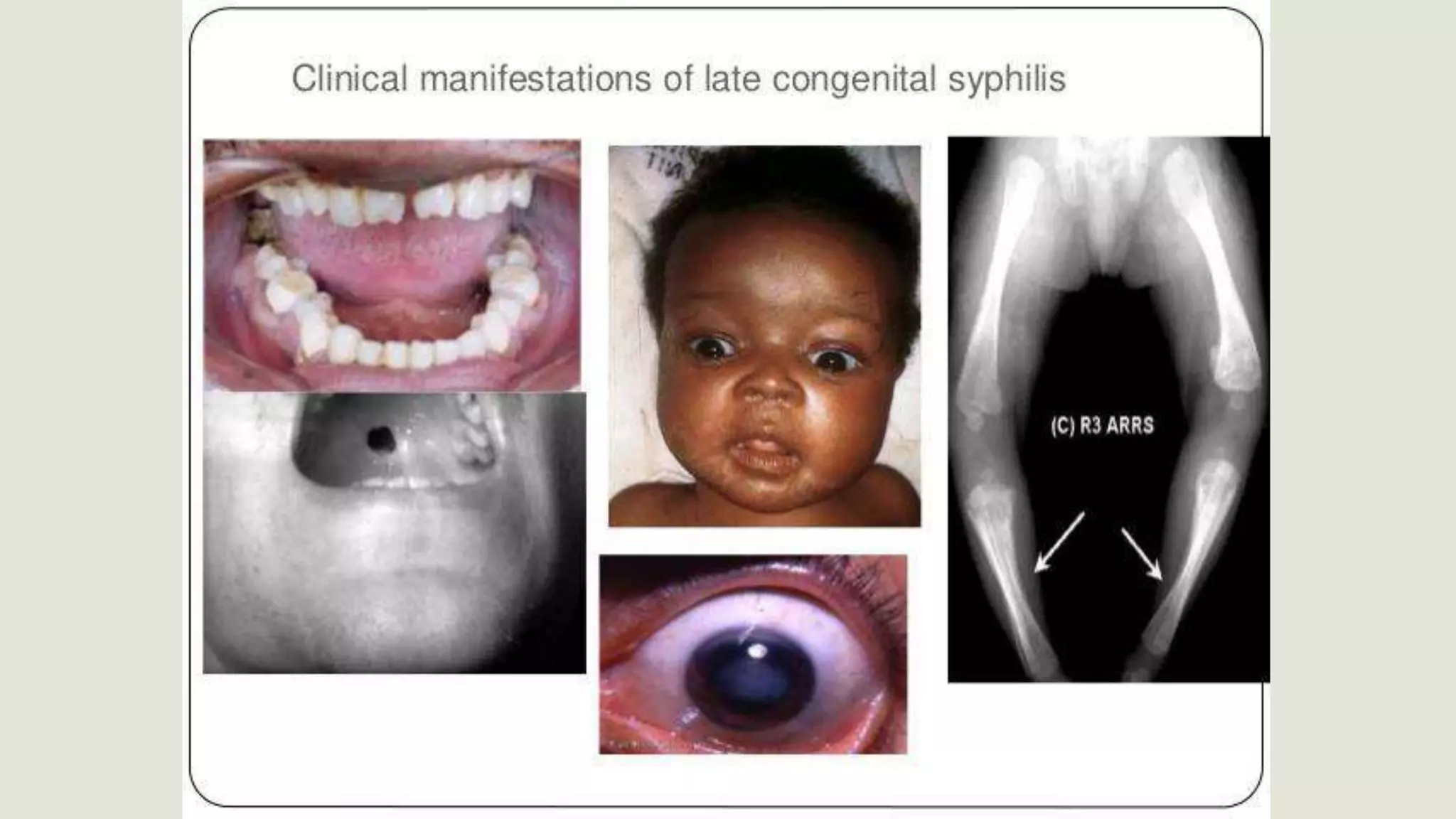 Bacterial Infections Of Oral Cavity Pptx