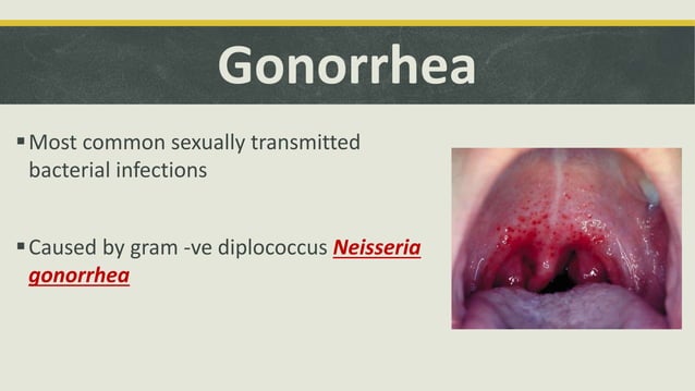 Bacterial Infections of Oral Cavity | PPTX | Ear, Nose and Throat ...