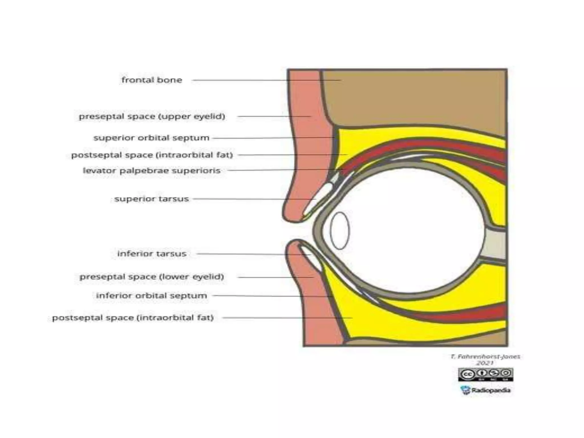 Preseptal and orbital cellulitis MD5 by Noel | PPTX