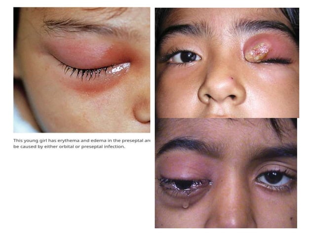 Preseptal and orbital cellulitis MD5 by Noel | PPTX