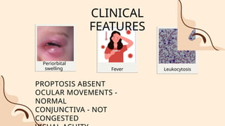 PRESEPTAL CELLULITIS.ppt ophthalmology | PPTX
