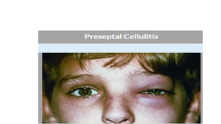 PRESEPTAL CELLULITIS AND ORBITAL CELLULITIS.pptx