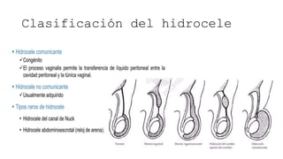 varicocele e hidrocele urologia presentacion | PPTX