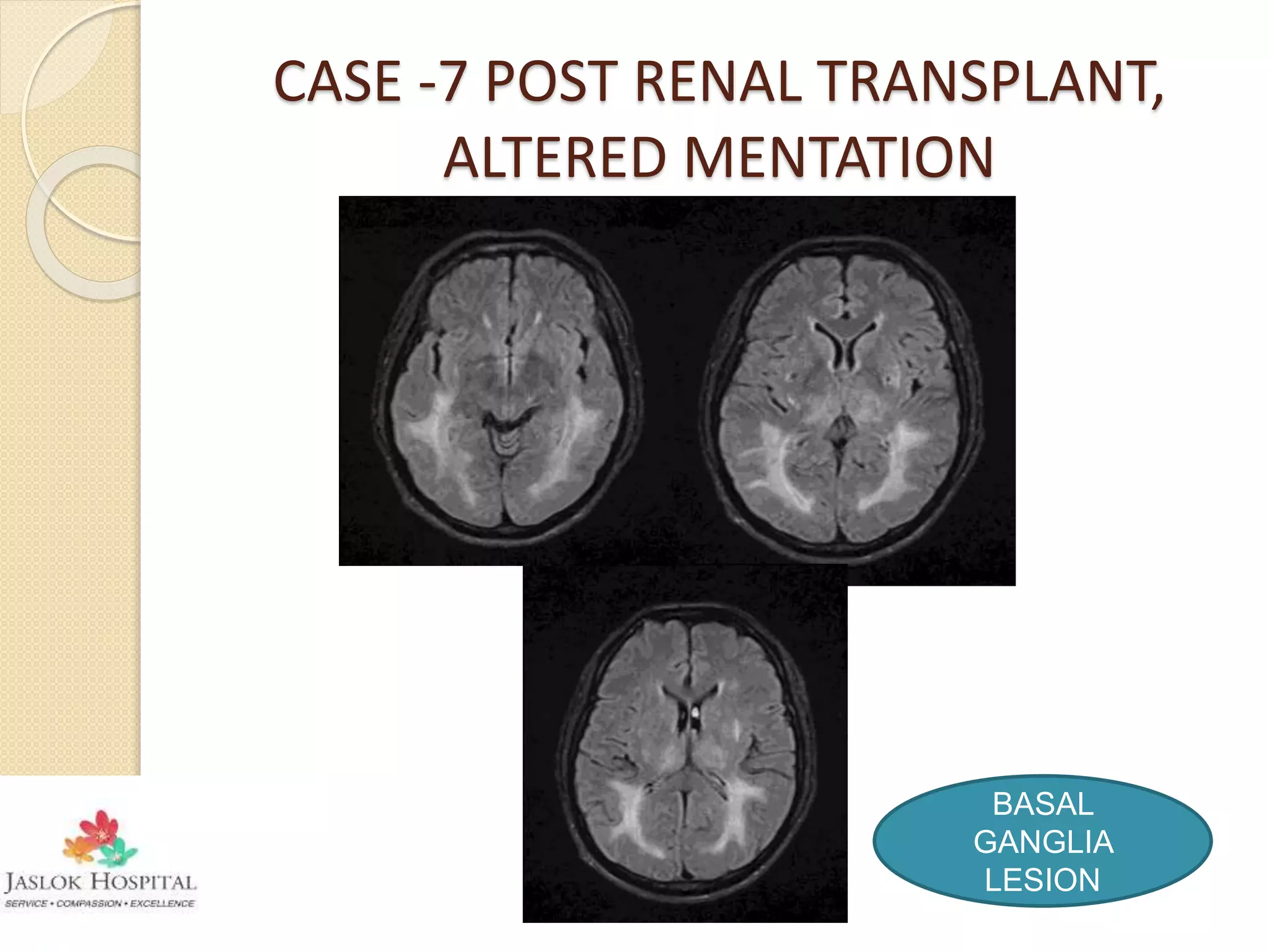 MRI SPECTRUM OF POSTERIOR REVERSIBLE ENCEPHALOPATHY SYNDROME | PPT