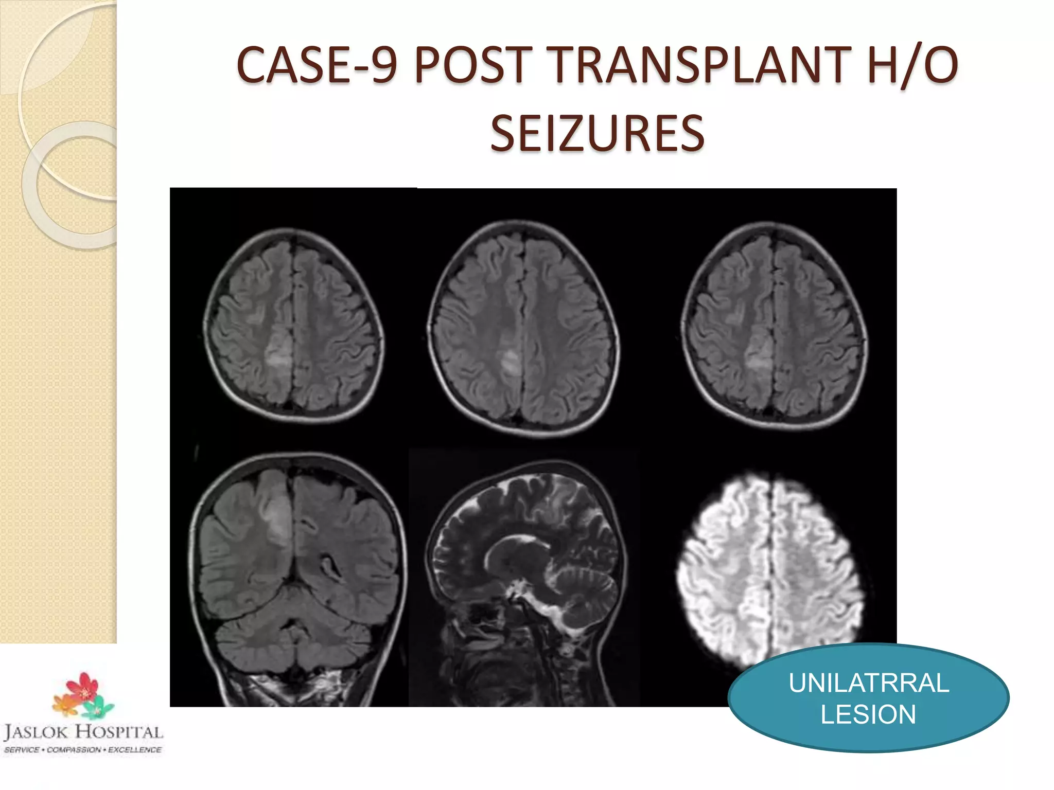 MRI SPECTRUM OF POSTERIOR REVERSIBLE ENCEPHALOPATHY SYNDROME | PPTX