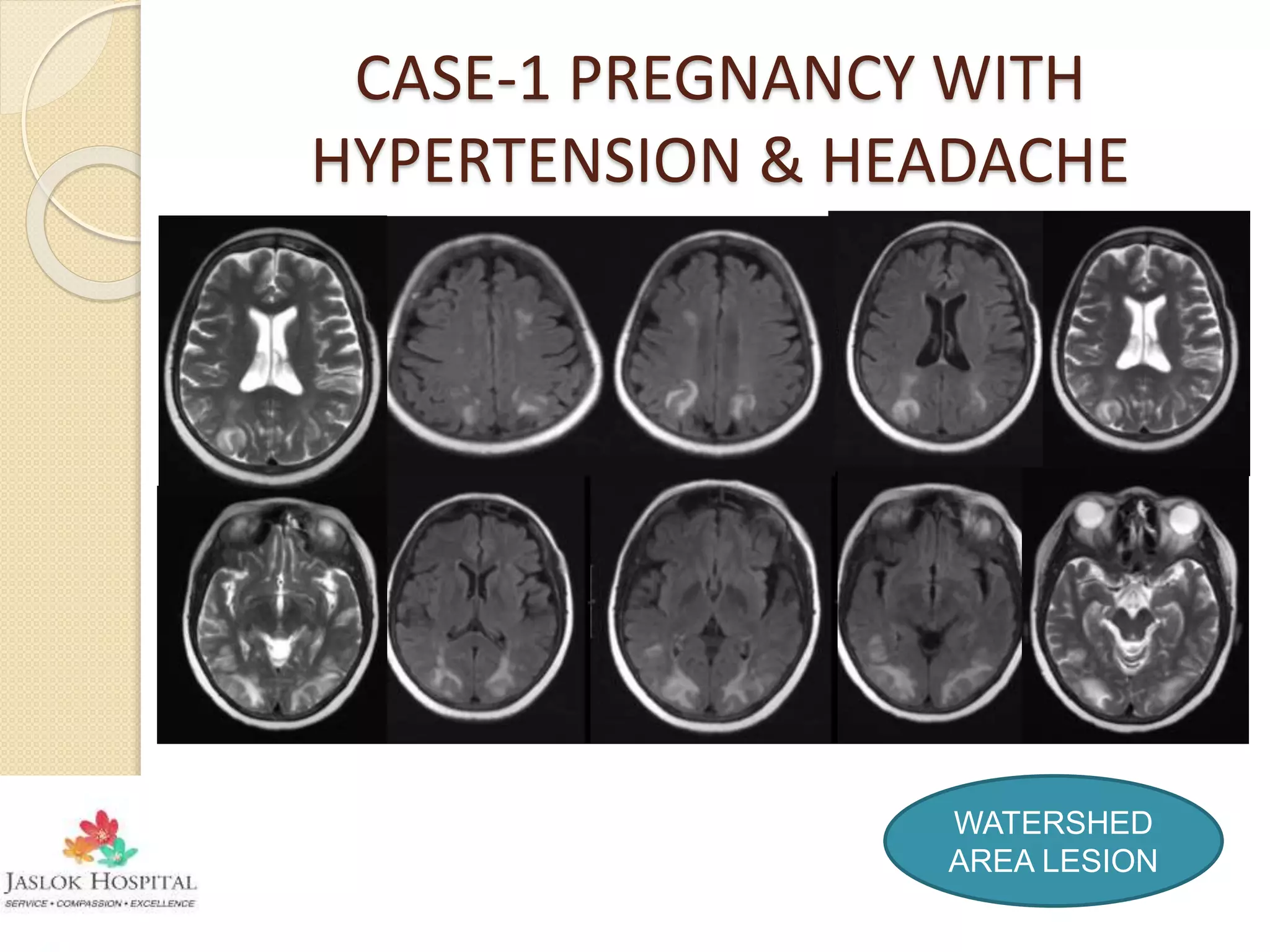 MRI SPECTRUM OF POSTERIOR REVERSIBLE ENCEPHALOPATHY SYNDROME | PPTX