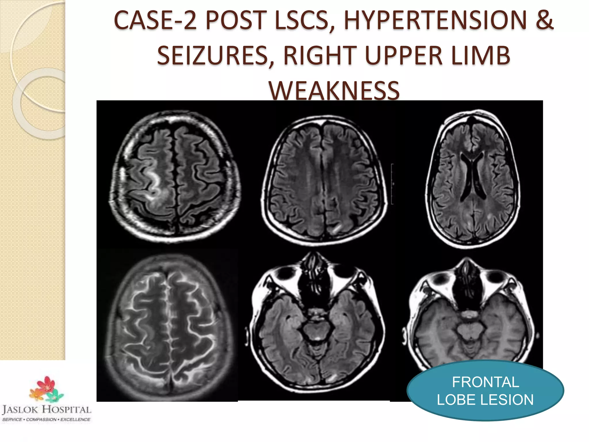 MRI SPECTRUM OF POSTERIOR REVERSIBLE ENCEPHALOPATHY SYNDROME | PPTX