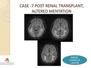 MRI SPECTRUM OF POSTERIOR REVERSIBLE ENCEPHALOPATHY SYNDROME | PPT