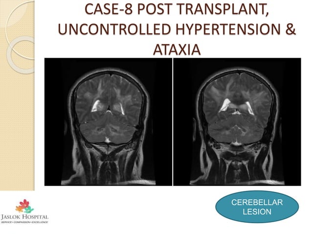 MRI SPECTRUM OF POSTERIOR REVERSIBLE ENCEPHALOPATHY SYNDROME | PPT