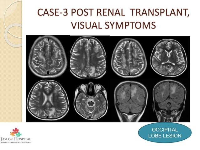 MRI SPECTRUM OF POSTERIOR REVERSIBLE ENCEPHALOPATHY SYNDROME | PPT