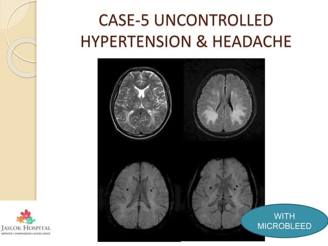 MRI SPECTRUM OF POSTERIOR REVERSIBLE ENCEPHALOPATHY SYNDROME | PPT