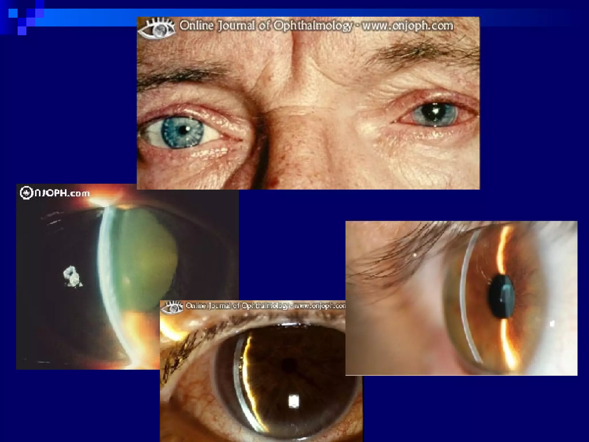 Presión Intraocular y Glaucoma | PPT