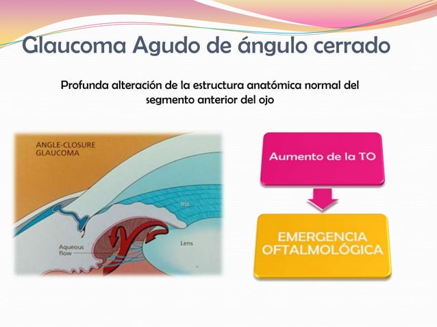 Presión intraocular y glaucoma | PPTX