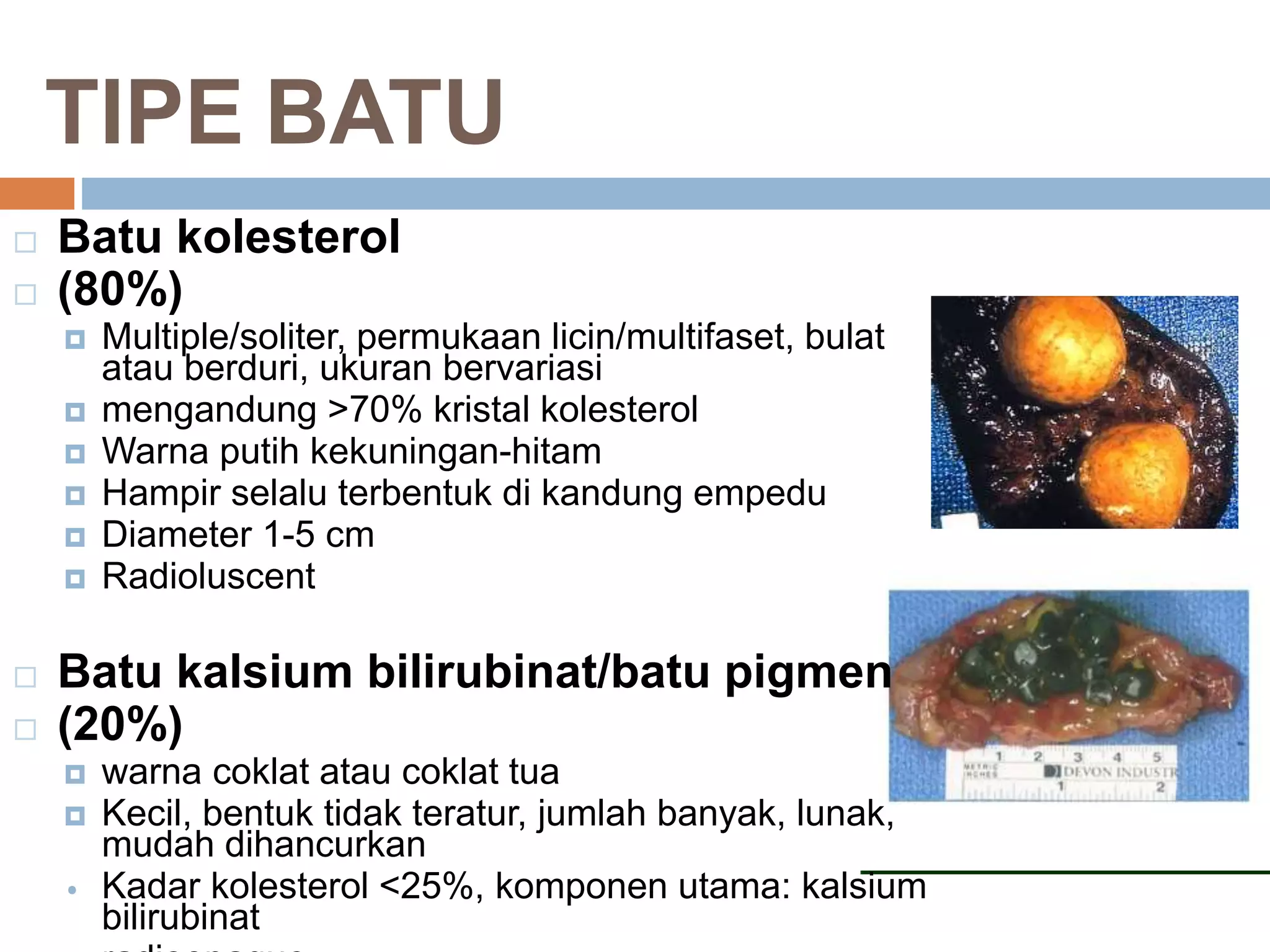 Preskas Cholelitiasis.ppt