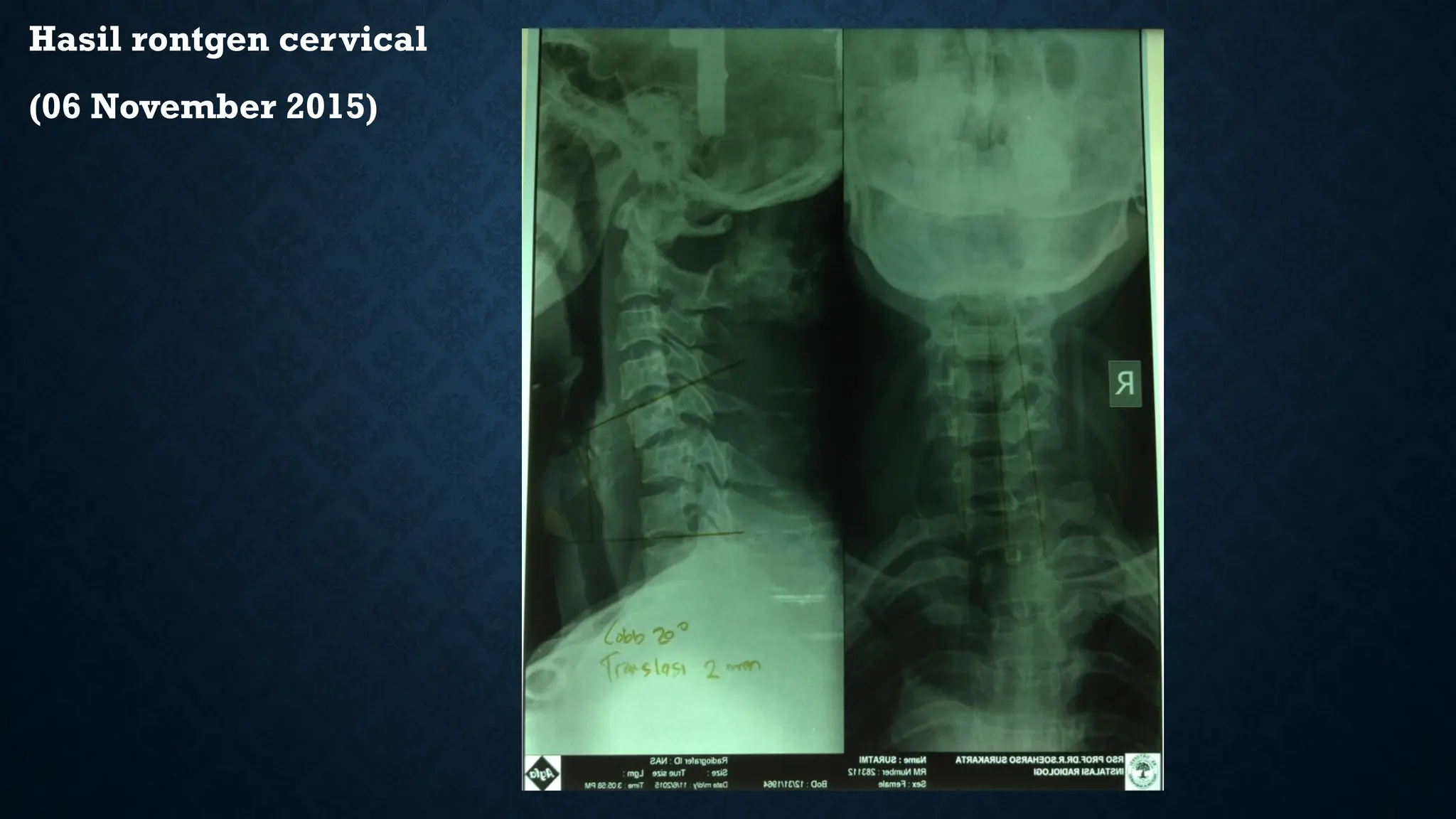 PRESKAS RSO unilateral facet joint dislocation.pptx