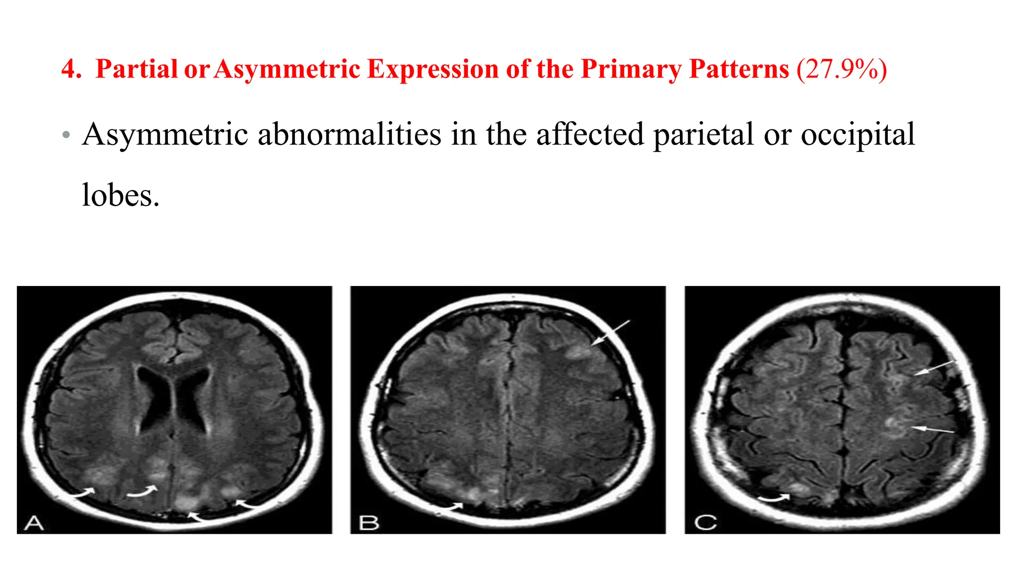 POSTERIOR REVERSIBLE ENCEPHALOPATHY SYNDROME | PPTX
