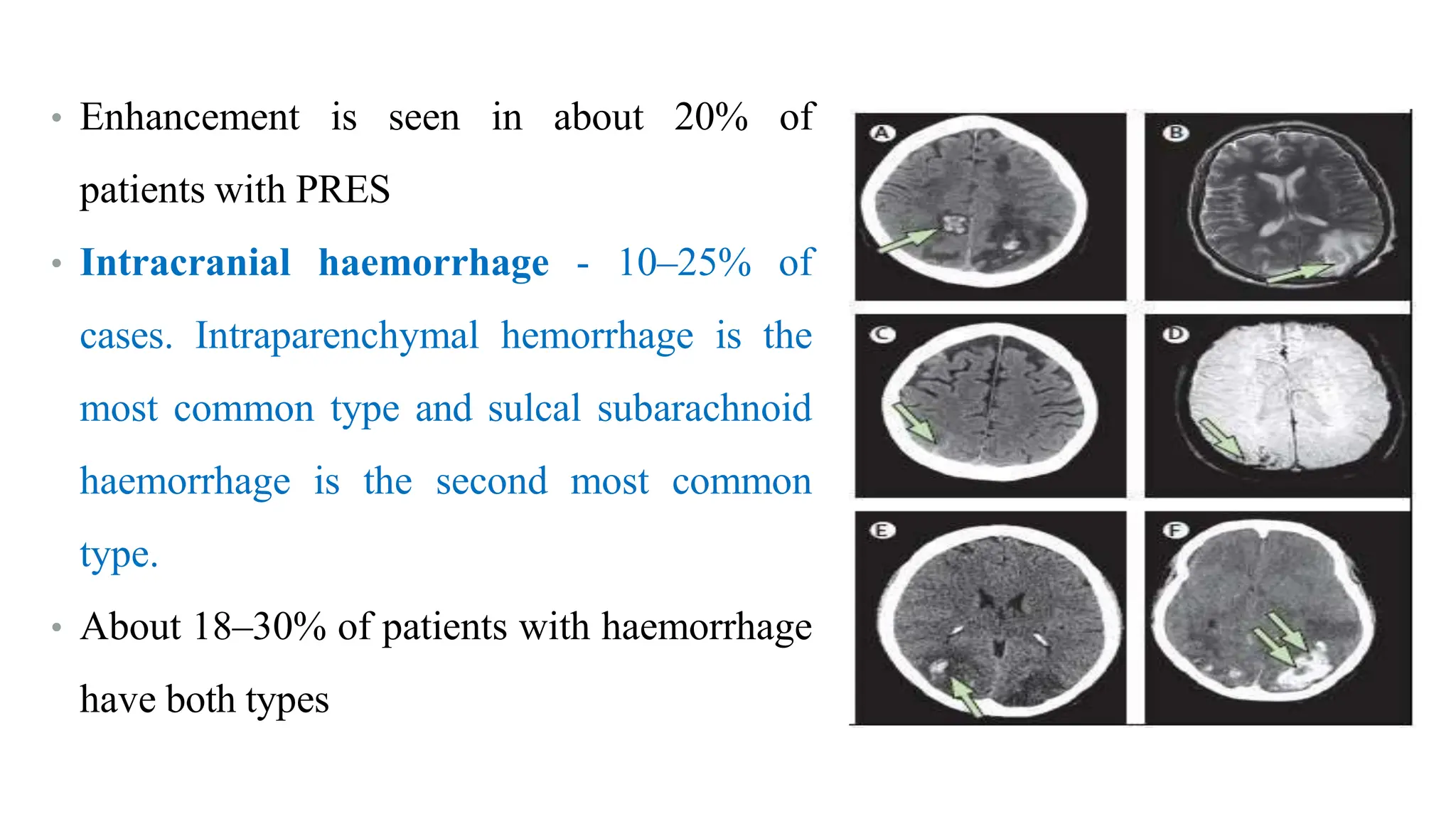 POSTERIOR REVERSIBLE ENCEPHALOPATHY SYNDROME | PPTX