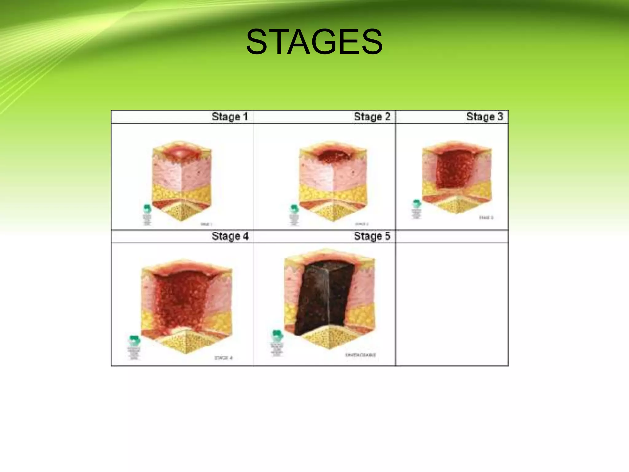 pressure-ulcer.ppt