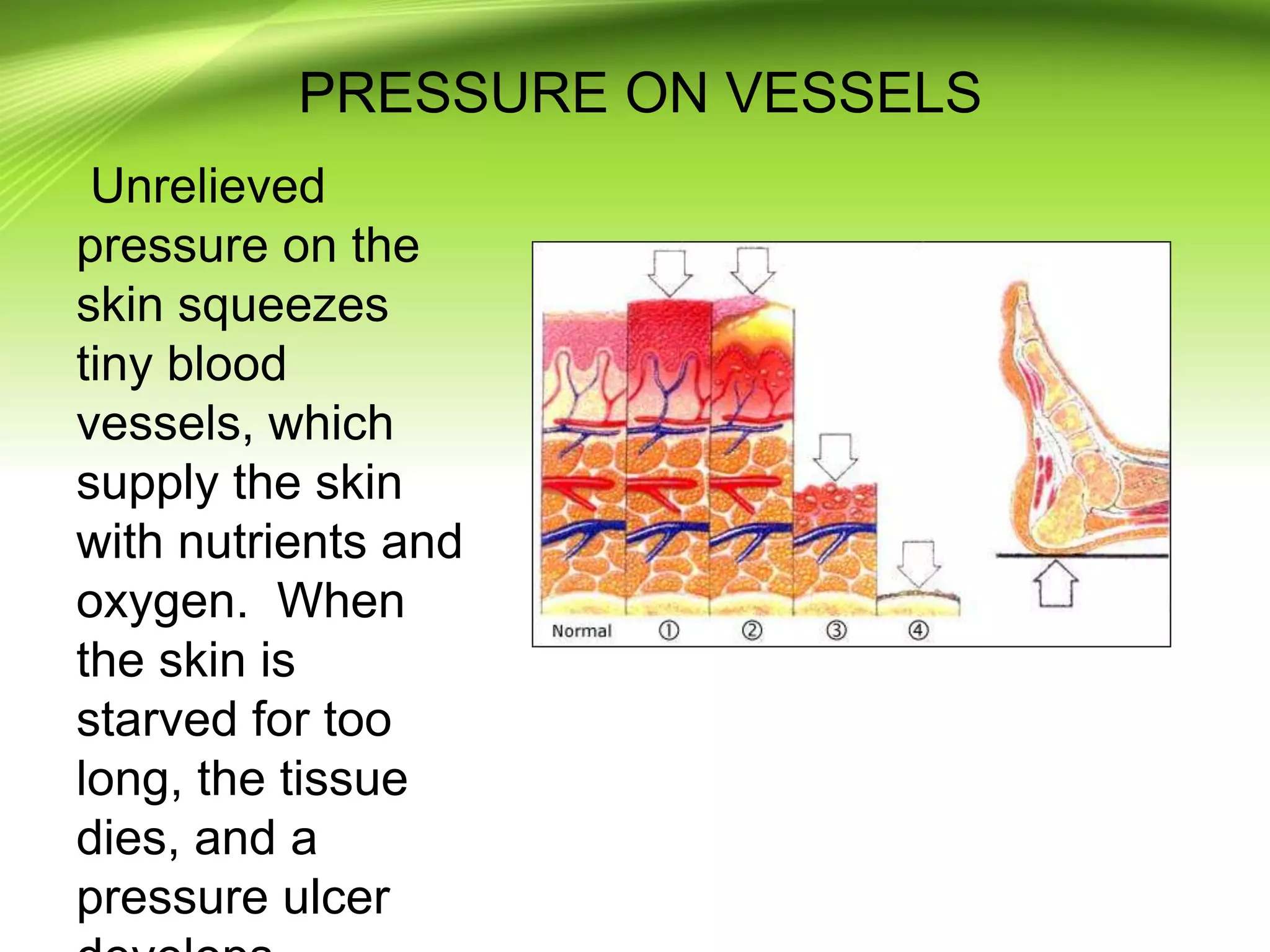 pressure-ulcer.ppt