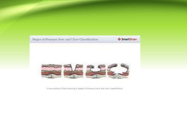 pressure-ulcer.ppt