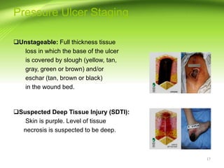 pressure-ulcer.ppt | Skin and Dermatology | Diseases and Conditions