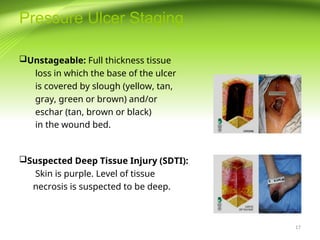 pressure ulcer prevention power point presentation | PPT