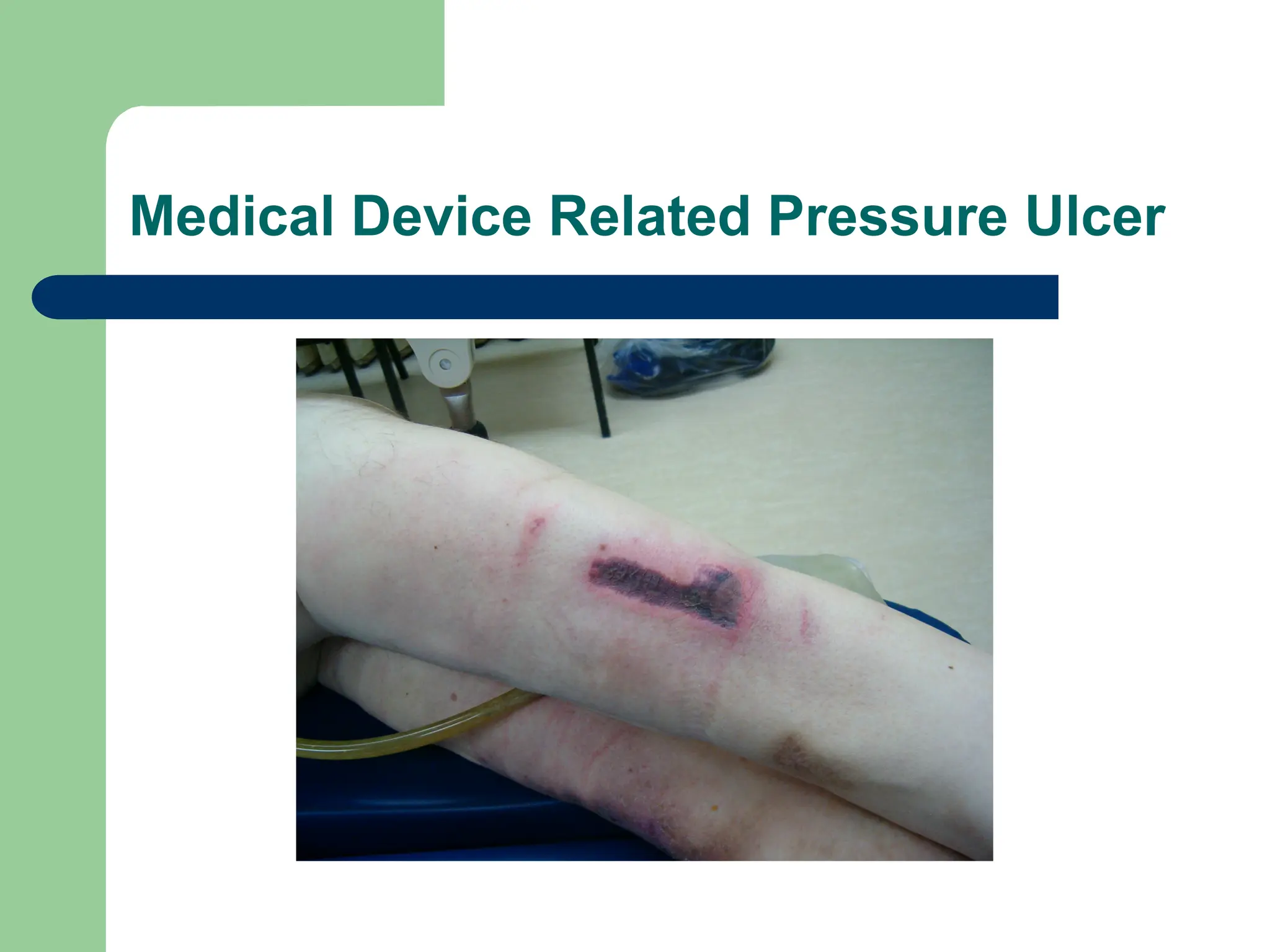 pressure-ulcers.pdffhfhfhfhfhhuhfhfhkhfhfhfuhriuhuh | PDF