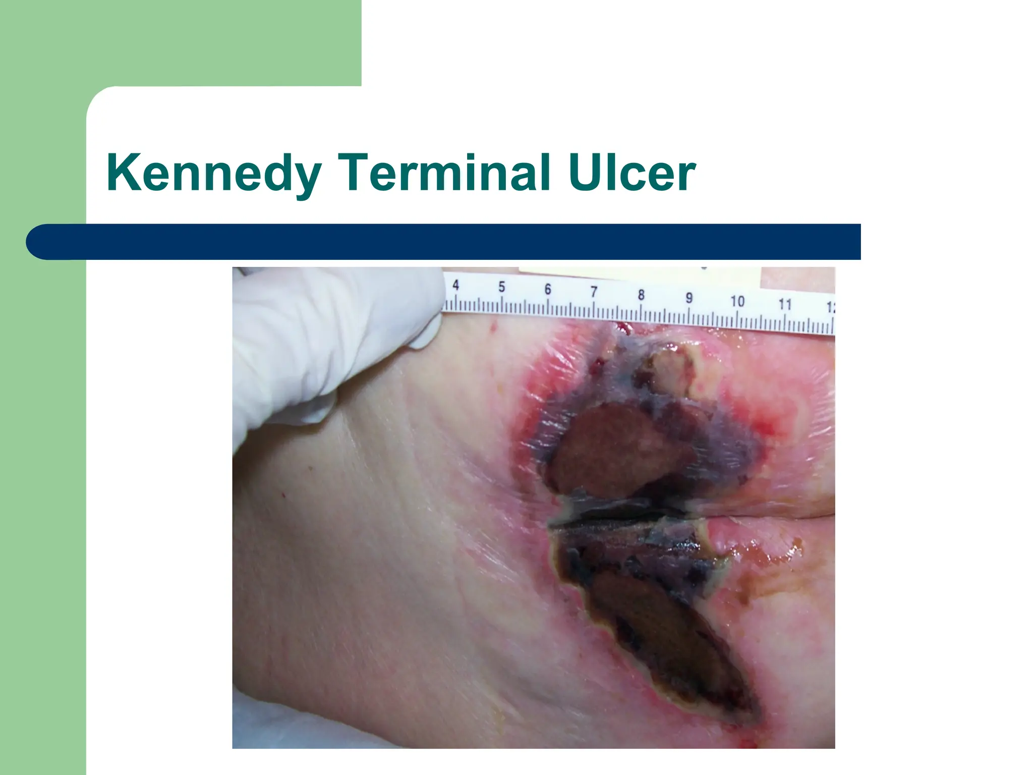 pressure-ulcers.pdffhfhfhfhfhhuhfhfhkhfhfhfuhriuhuh | PDF