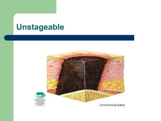 pressure-ulcers.pdffhfhfhfhfhhuhfhfhkhfhfhfuhriuhuh | PDF