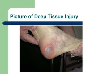 pressure-ulcers.pdffhfhfhfhfhhuhfhfhkhfhfhfuhriuhuh | PDF | Death ...