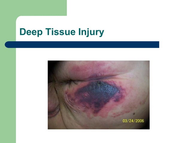 pressure-ulcers.pdffhfhfhfhfhhuhfhfhkhfhfhfuhriuhuh | PPT