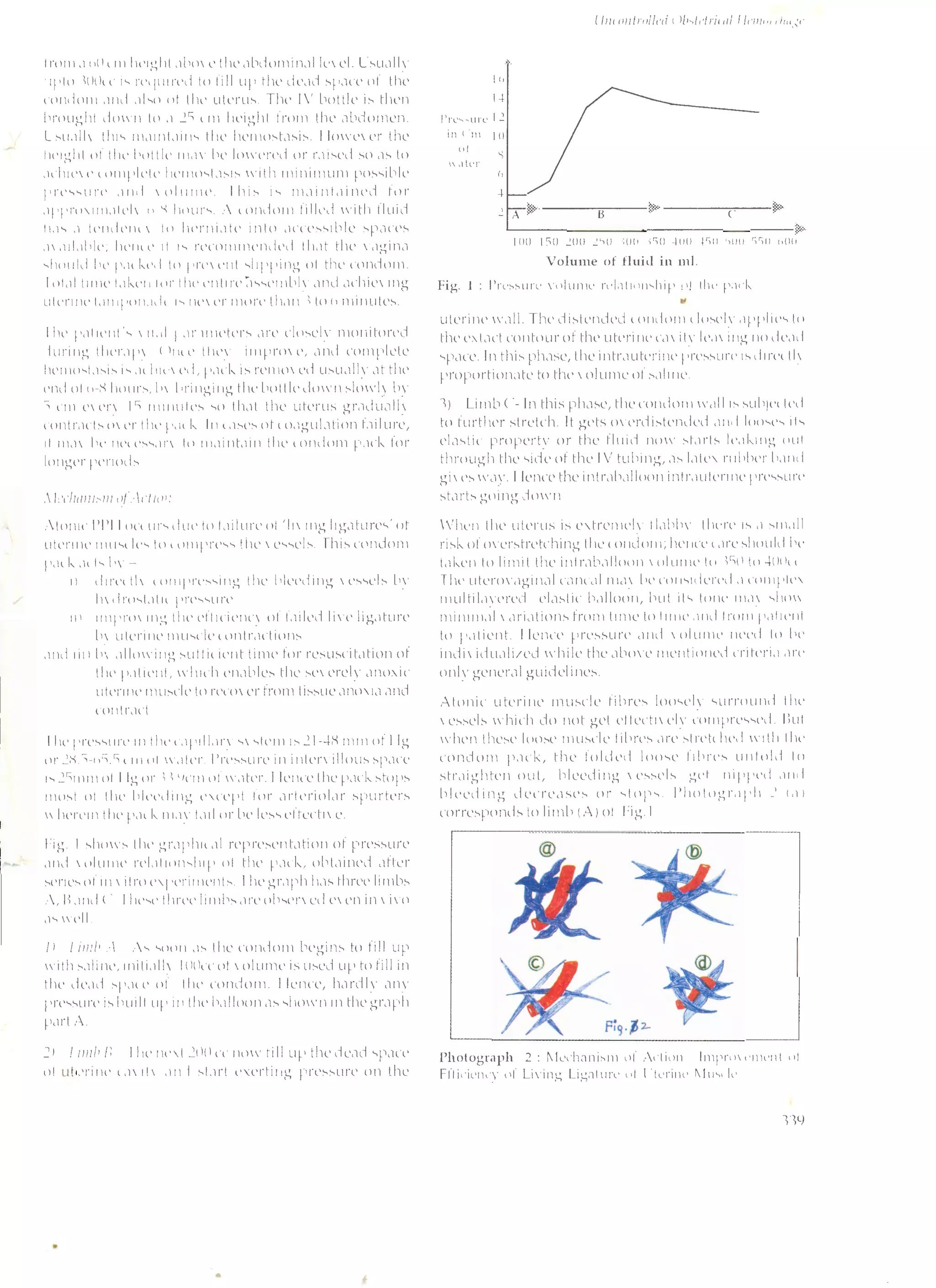 PPH, Pressure Balloon Therapy in Uncontrolled Obstetrical Hemorrhage | PDF