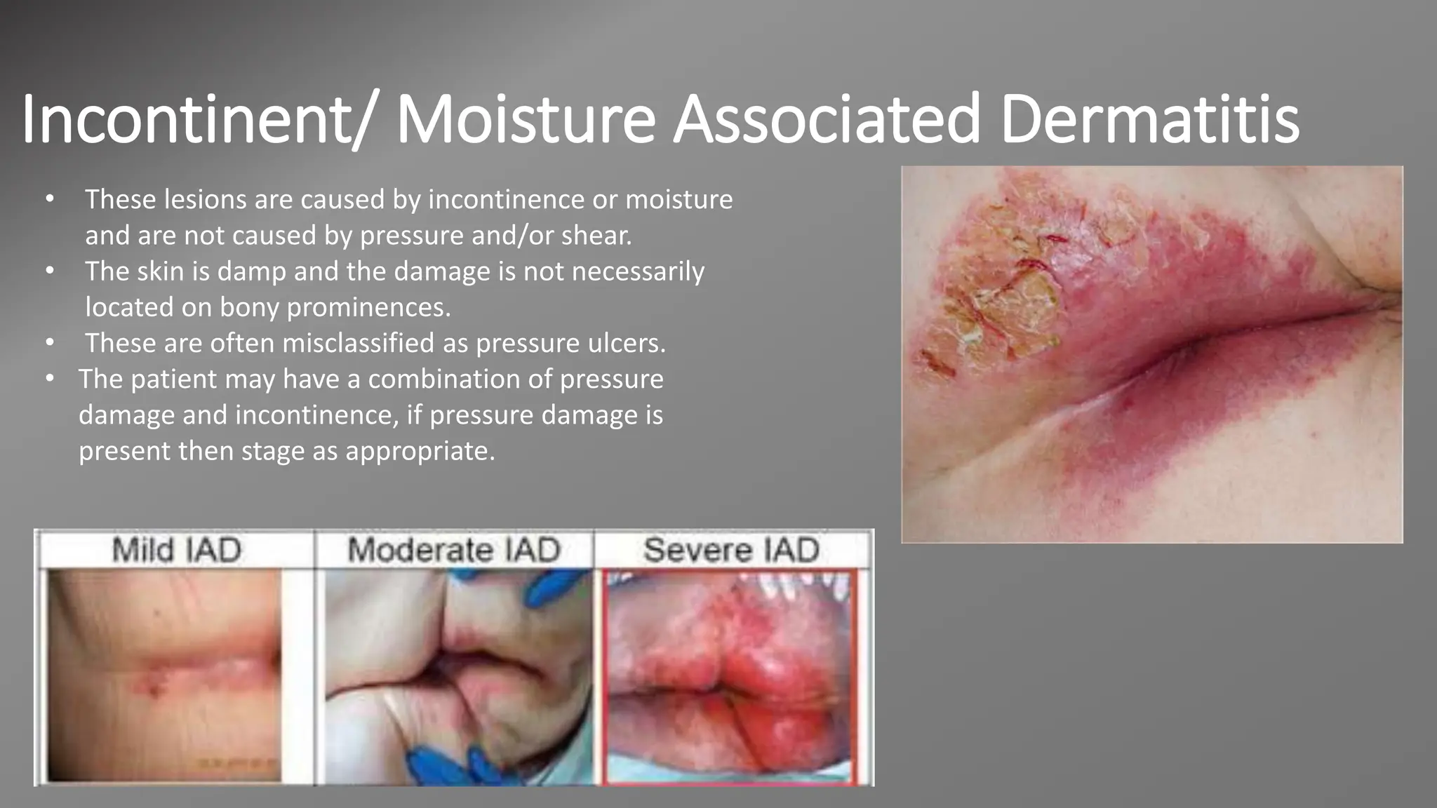 say no to pressure injury(pathophysiology, prevention, management) | PPTX