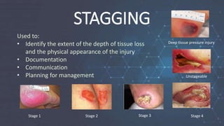say no to pressure injury(pathophysiology, prevention, management) | PPTX
