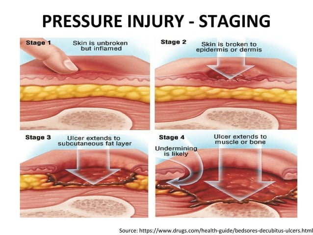 Pressure Injury | PPT | First Aid | Injuries