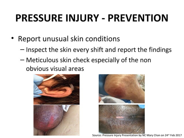 Pressure Injury | PPT | First Aid | Injuries