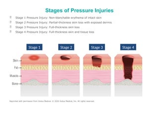 pressure injury prevention in the operation theatre | PPTX