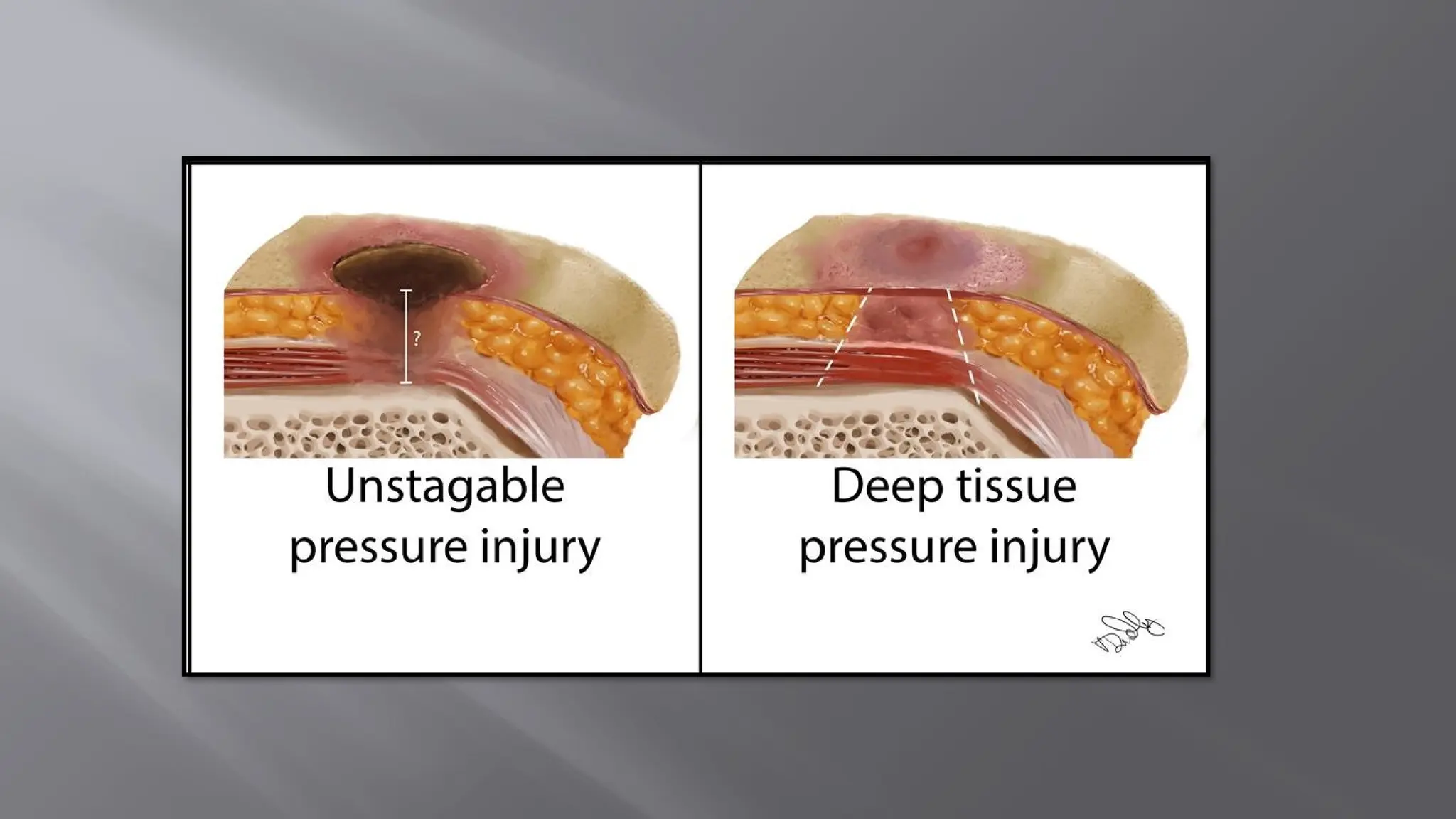 PRESSURE INJURY PREVENTION & MANAGEMENT.pptx